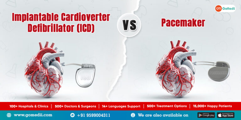 Implantable Cardioverter Defibrillator (ICD) Vs Pacemaker - GoMedii Blog