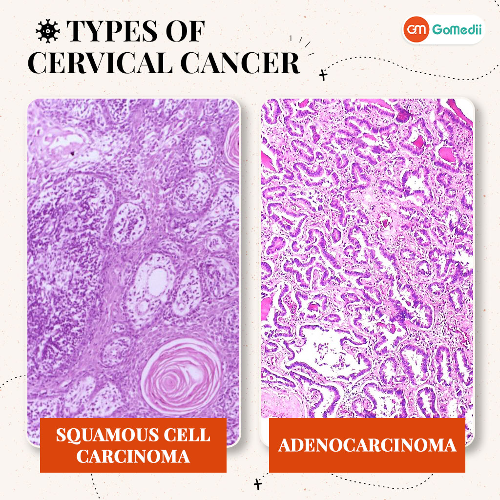 Cervical Cancer: Causes | Symptoms | Treatment Cost - GoMedii Blog